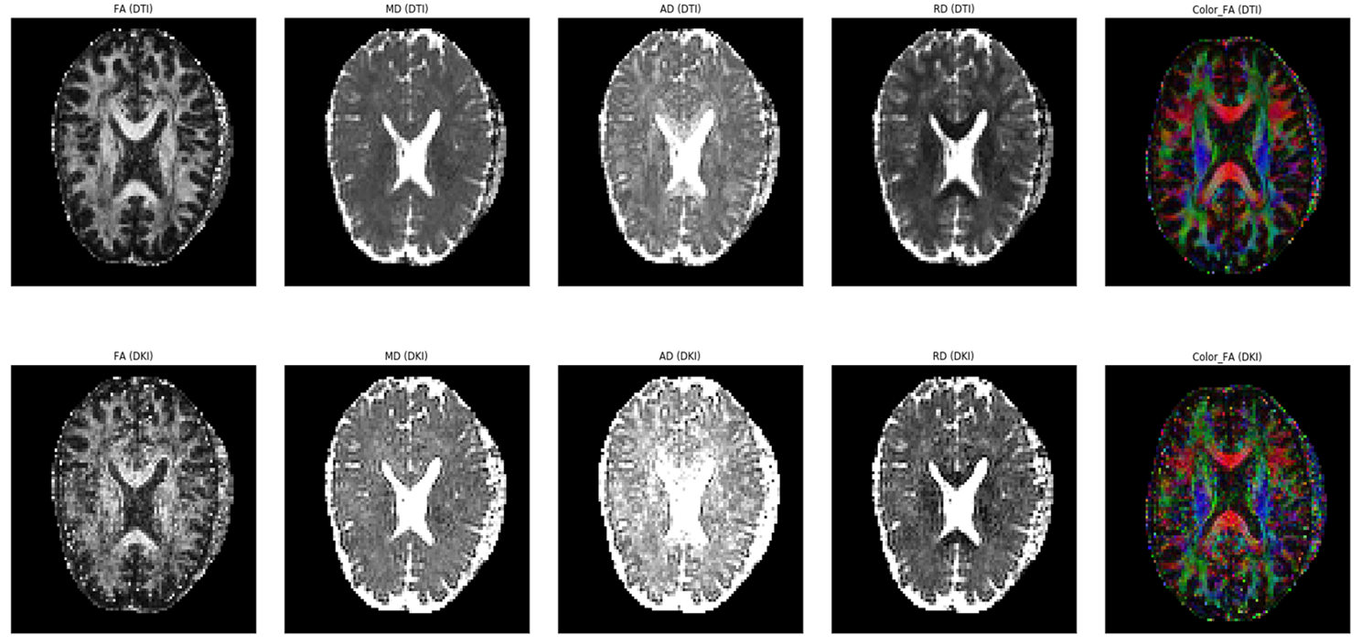 Detection of Early Neurodegeneration with DTI - Medcine/AI